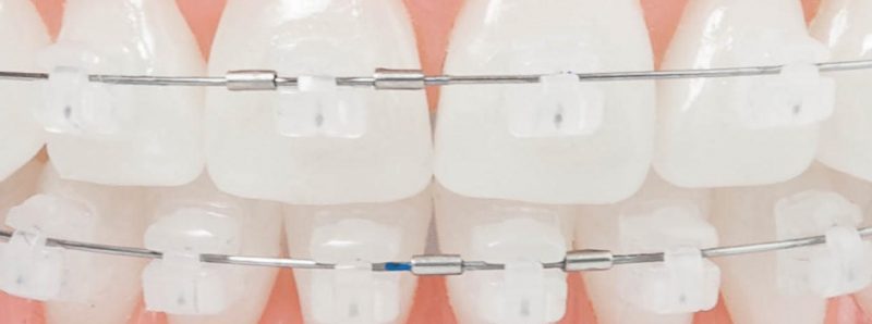 Brackets de Baja Fricción | Clínica Dental Altozano, Albacete ... Brackets de Baja Fricción | Clínica Dental Altozano, Albacete ...